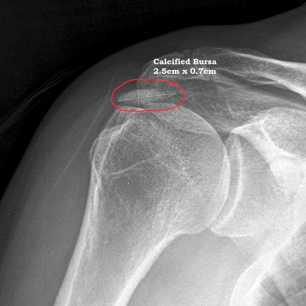 Shockwave - Highland Chiropractic Clinic